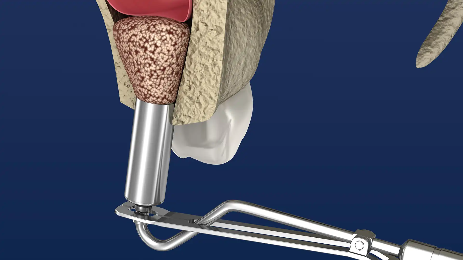 Advanced Dental Singapore | Bone Graft Surgery