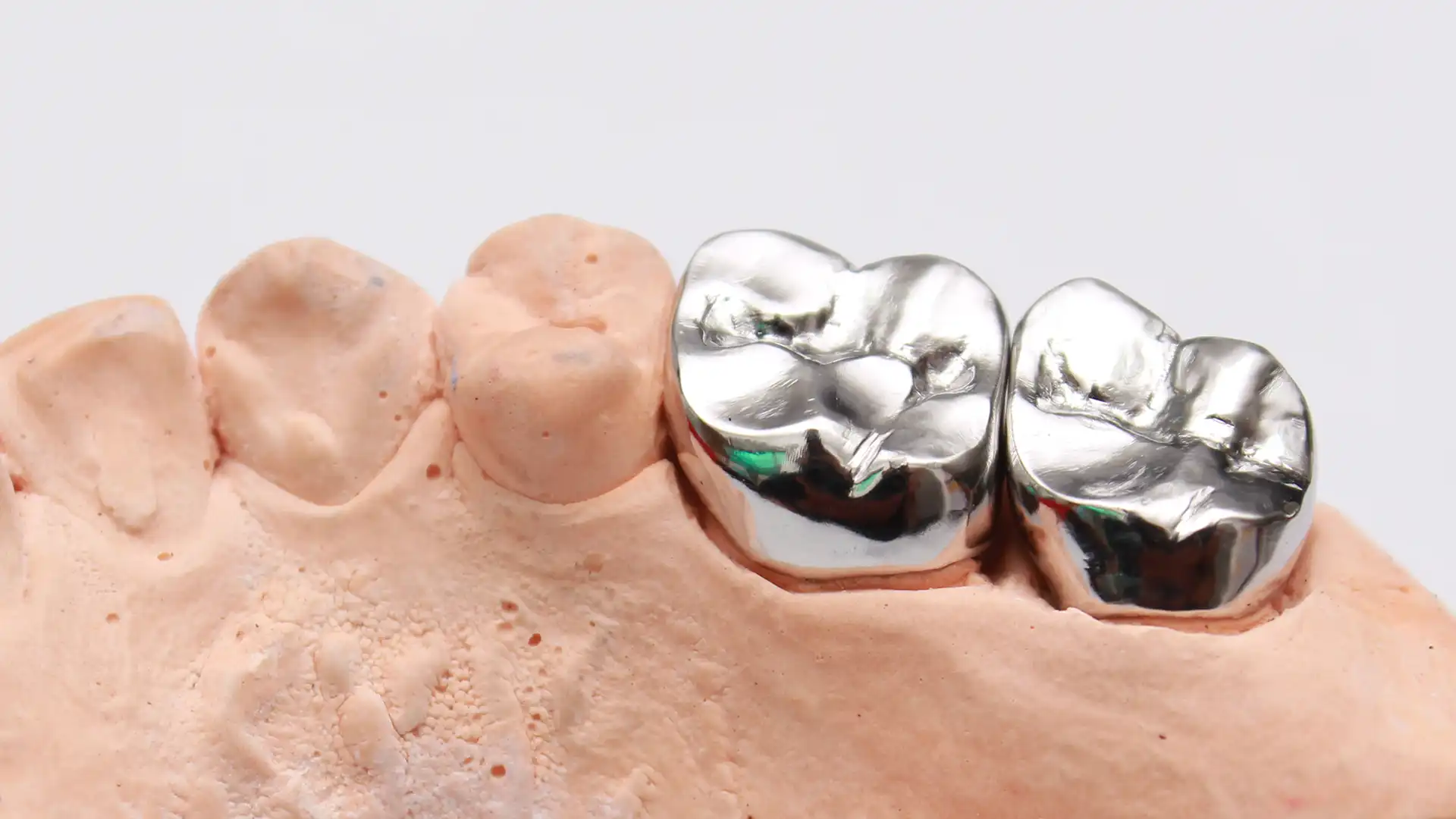 Advanced Dental Singapore | Crowns and Bridges