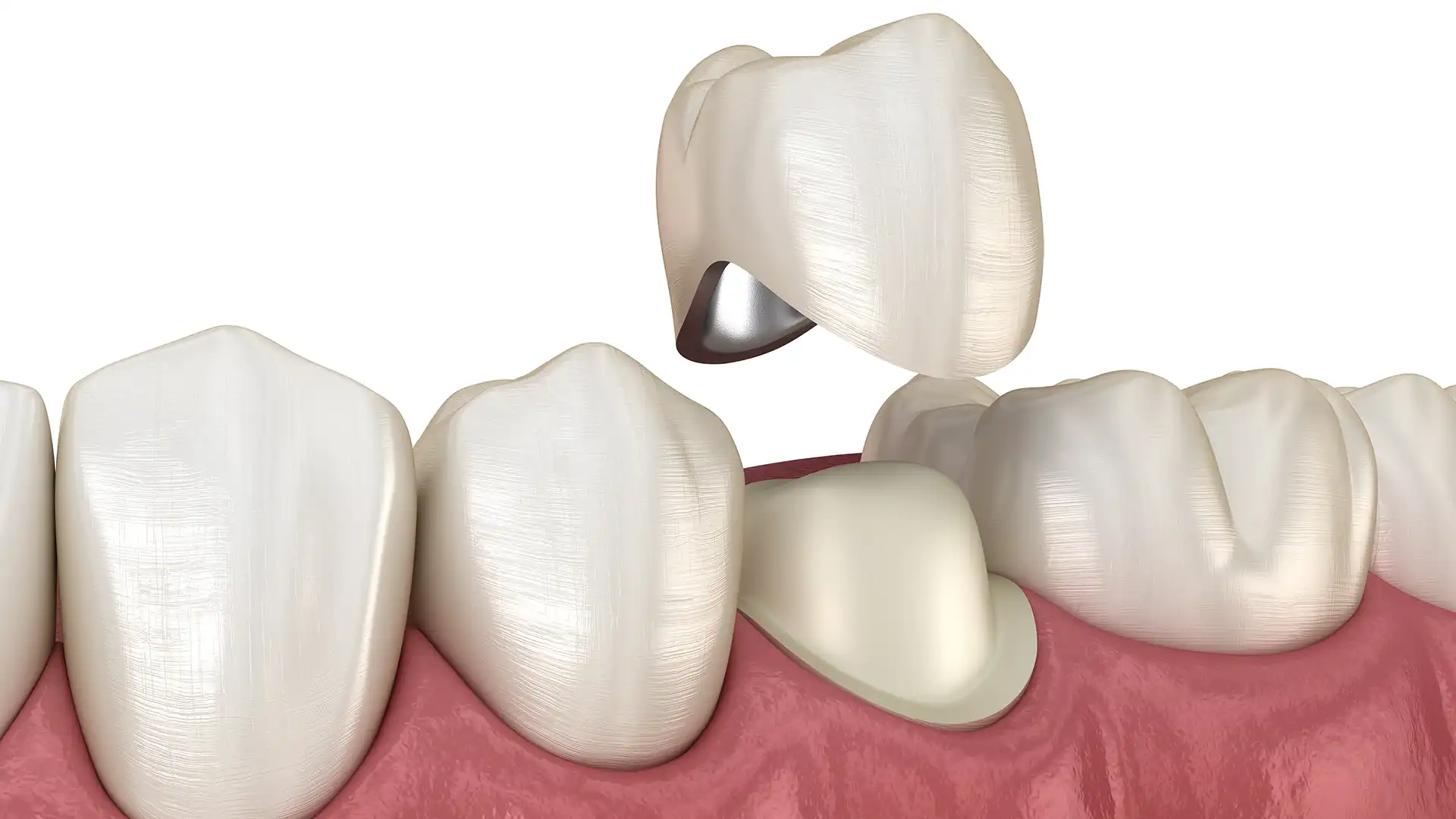 Advanced Dental Singapore | Crowns and Bridges